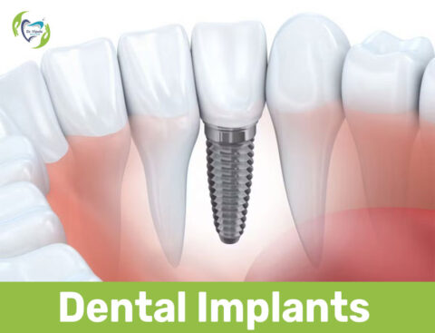 Dental Implants - drvipuladentalclinic.com